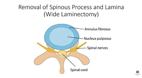 Back Surgery Part 2 How Back And Neck Surgery Can Damage The Spine