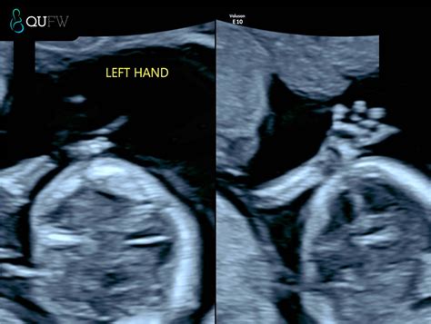 Nuchal Translucency Early Anatomy Pre Eclampsia Screening Qufw