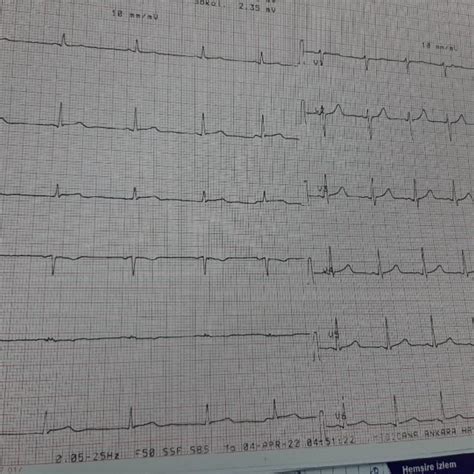 Ecg Shows Repolarization Abnormalities Leads Ii Avf And Iii Table 1 Download Scientific