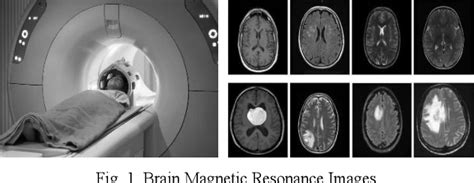 Figure 1 From Pioneering Early Parkinsons Disease Detection With Deep Learning And Image