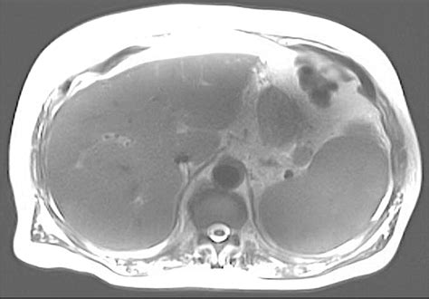Multiple Myeloma Presenting As Acute Liver Failure Acg Case Reports