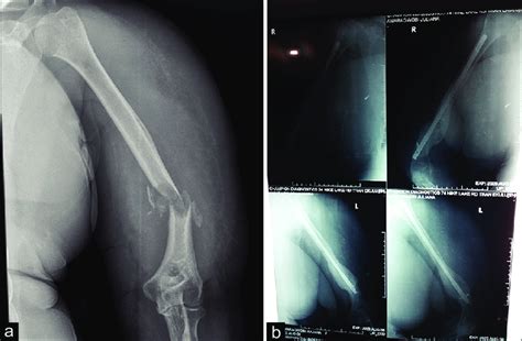 A X Ray Showing Pathological Humeral Fracture Of The Distal Third Of