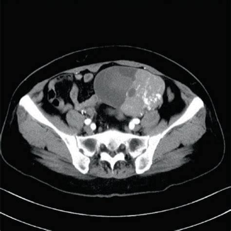 Imaging Of The Uterine Lipoma And The Ovarian Tumor The Uterine Lipoma