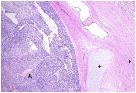 Transformed Testicular Teratoma To Embryonic Type Neuroectodermal Tumor