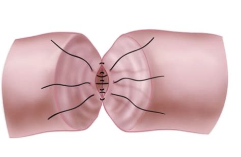 Vasectomy Procedure Reversal