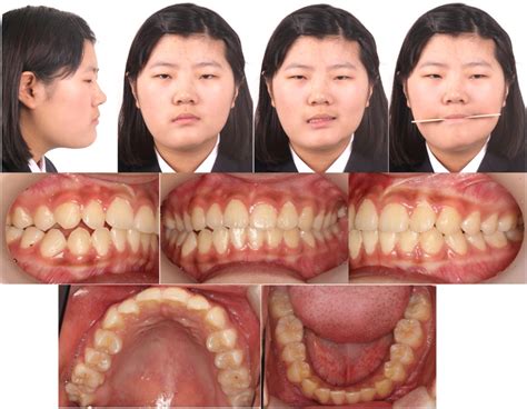 Hemimandibular Hyperplasia Treatment With Condylectomy And Orthodontic Camouflage Treatment