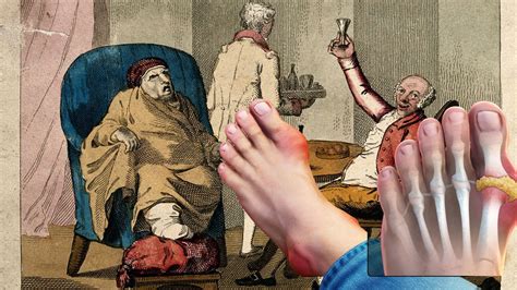 Why Gout Was Called The Disease Of Kings