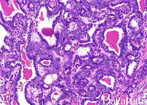 肺上皮 肌上皮癌