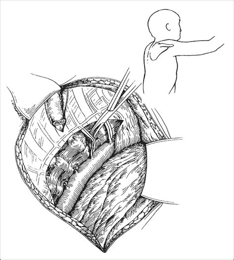 Lumbar Spine Exposure Technique At Nancy Jensen Blog