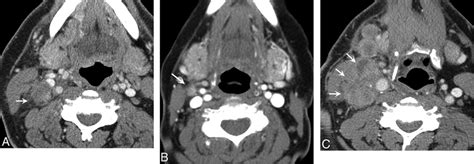 A A Right Level Iia Lymph Node Arrow In A Patient With Ocscc This