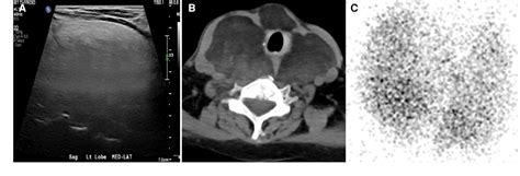 Figure 2 From A Case Of Diffuse Thyroid Lipomatosis With Amyloid