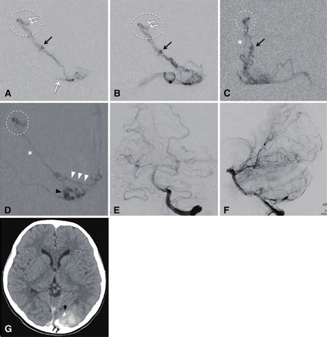 At The Repeated Angiography 1 Week After The Onset Sa Was Performed Download Scientific