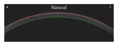 The Corneal Deformation Processes During Air Puff From Corvis St Due