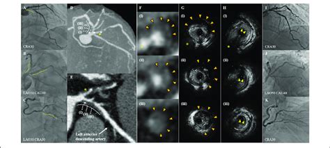 Multimodal Images In Case 1 A C Coronary Angiography CAG Showing Download Scientific