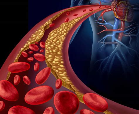 Arterioskleroza Simptomi Prehrana Čaj Za Liječenje Arterioskleroza