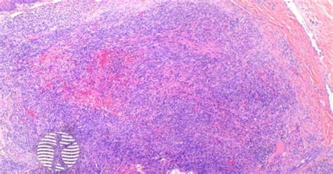 Kaposi Sarcoma Pathology Image