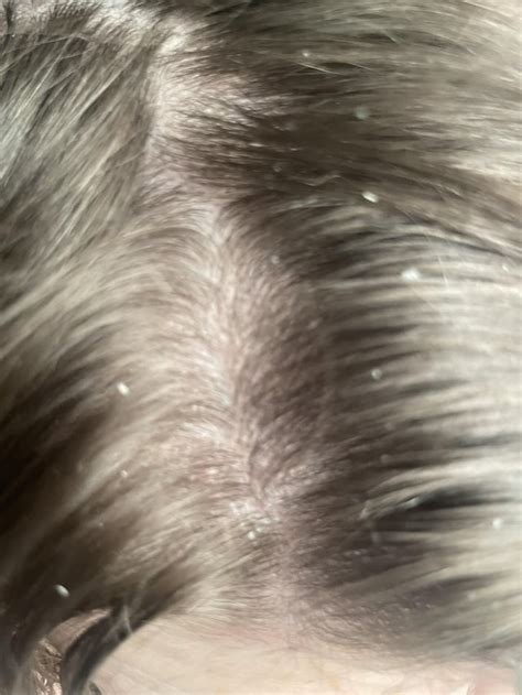 Terrible Scalp Condition R Dandruff