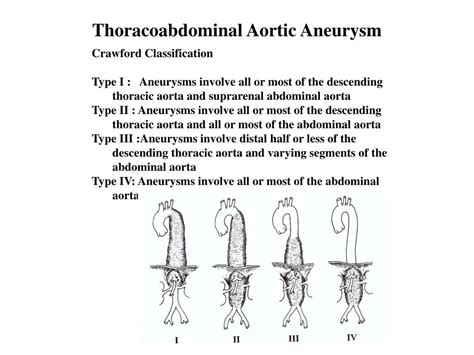 Ppt Aortic Aneurysm Powerpoint Presentation Free Download Id6599578