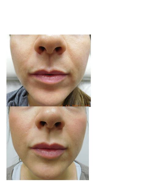Lip Enhancement Gallery Ptreecemd