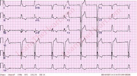 Left Bundle Branch Block Ecg Example 4 Learn The Heart