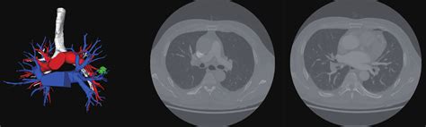 Preoperative Lobectomy Simulation According To The 3d Ctba Digital Download Scientific Diagram