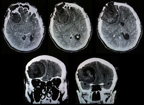Simple Skull Tomography Images Where Lesion With Important Extra Axial