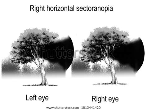 Different Patterns Visual Field Defects Neurological Stock Illustration Shutterstock