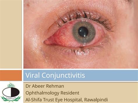 Viral Conjunctivitis And Its Managmentpptx
