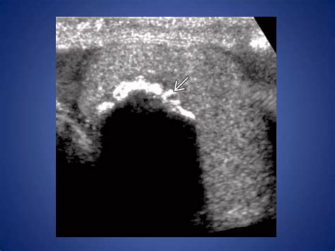 Testicular Calcifications Pdf