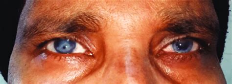 Healing Phase Of Corneal Melting In Right Eye And After Tectonic