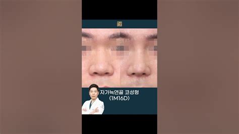 자가늑연골 코성형 한 썰푼당 남자코성형 Youtube