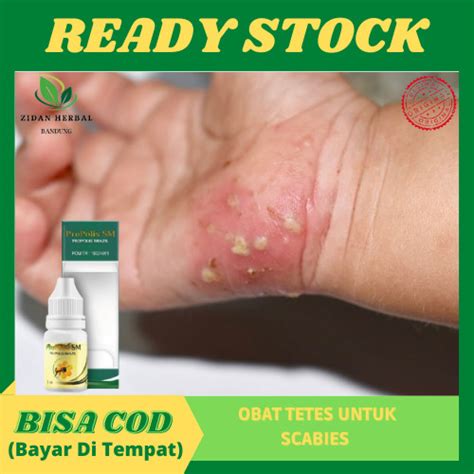 Jual Salep Scabies Kudis Gatal Bernanah Infeksi Kulit Akibat Tungau