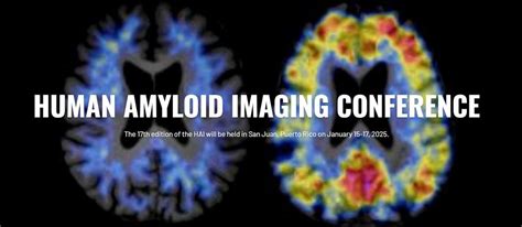 Hai Hai25 Imaging Alzheimersresearch Farida Sheik