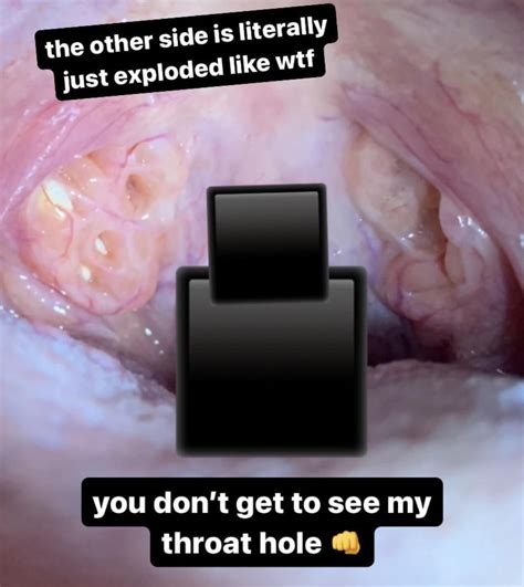 Severe Tonsil Stones Gettting Tonsils Removed Soon R Tonsilstones