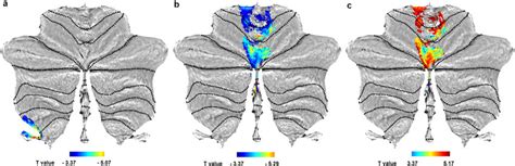 Correlation Between Altered Gm Volume And Clinical Assessment Flatmap