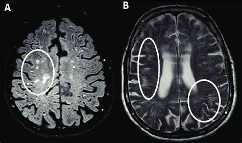 Showing Multiple Areas Of Hyperintensity In The Subcortical Areas On