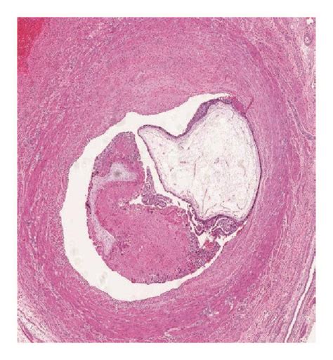 A Ct Scan Without Contrast Revealed Large Right Complex Adnexal Mass