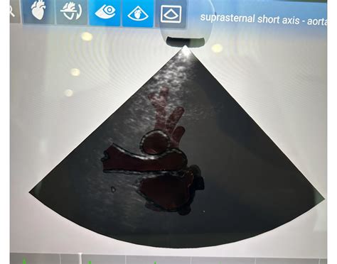 Suprasternal Short Axis — Printable Worksheet