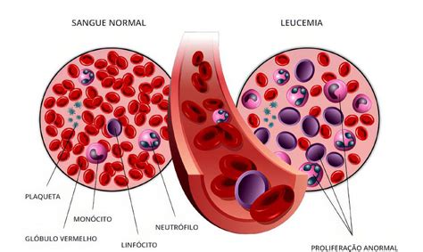 Anvisa Autoriza Pesquisa Em Pacientes Com Leucemia Linfoide Aguda B O