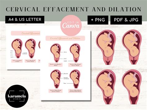 Cervical Effacement And Dilation Png Images And Canva Pdf 