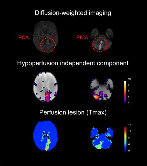 Hics Detect Multiple Perfusion Deficits Affecting Different Vascular Download Scientific