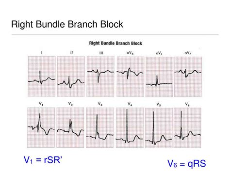 Ppt Ventricular Conduction Disturbances Powerpoint Presentation Free