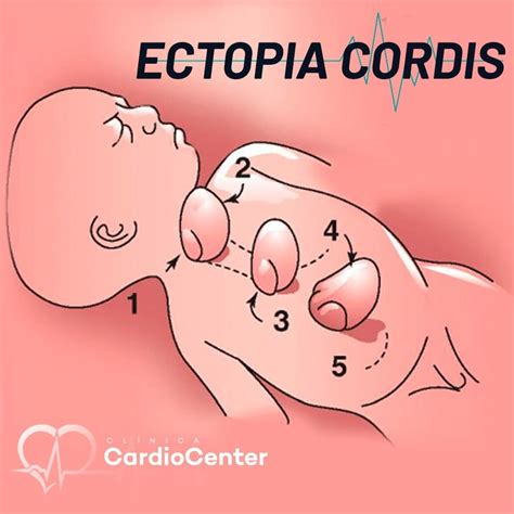 Ectopia Cordis Clínica Cardiocentro Jinotega Matagalpa Facebook