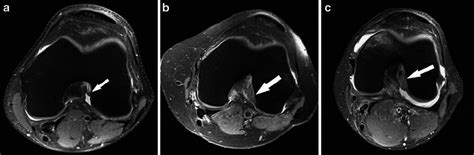 Axial Fs Intermediate Weighted Mr Images Showing The Acl Configurations Download Scientific