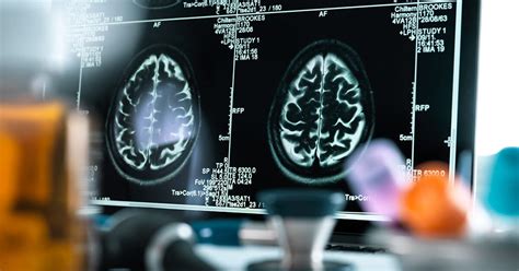 Ischemic Vs Hemorrhagic Stroke
