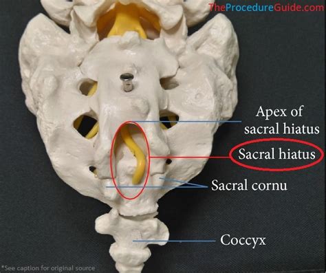 Epidural Space Injection
