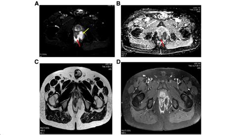 Extra Sphincteric Perianal Abscess Grade 4 A Dwi Trace Image Showing