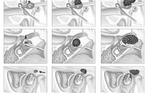 Ear Tumor Anatomy Oto Surgery Atlas