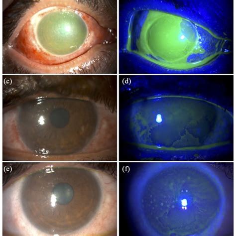 Roper Hall Classification Of Chemical Eye Injury Download Scientific