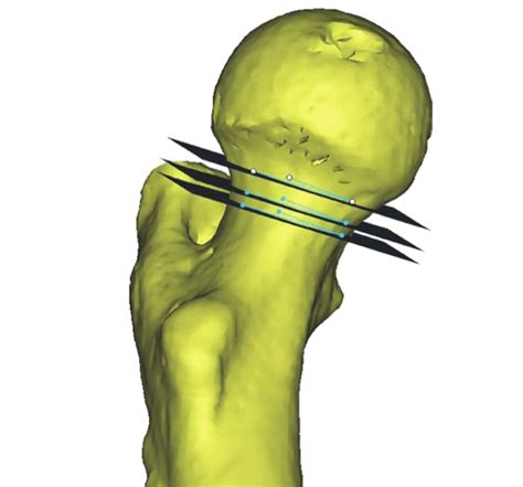 A 3 Dimensional Bone Model Created From The Computed Tomography Scan Download Scientific